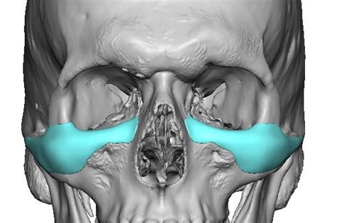 Male Vs Female Custom Midface Implant Strategies Explore Plastic Surgery