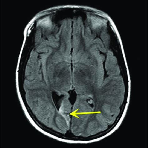 Right Occipital Intracerebral Calcifications On Preoperative Ct Download Scientific Diagram