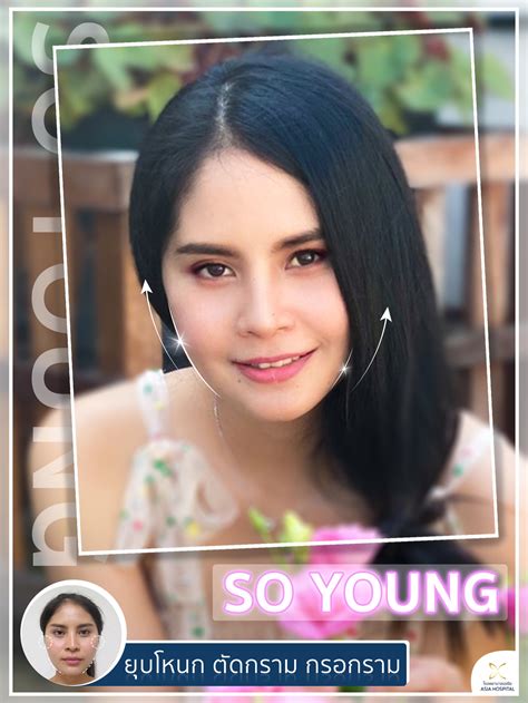 จัดหน้าใหม่ แผลเล็ก เสริมจมูก เอเชียคลีนิก หมอทนงศักดิ์