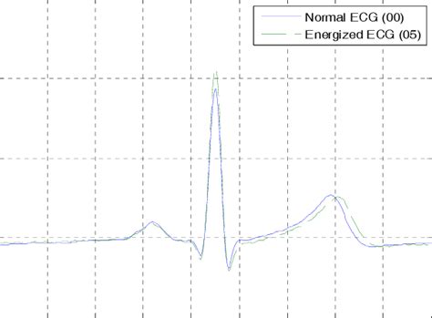 ECG Signal Comparison Before And After Having Caffeinated Beverage Download Scientific Diagram