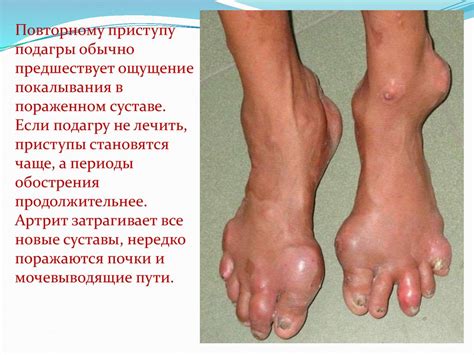 Подагра. Диагностика - презентация онлайн
