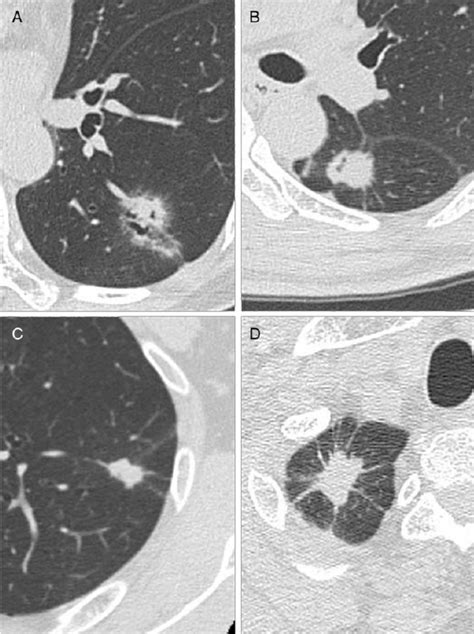 A A 58 Year Old Female Had A 28 Cm Part Solid Nodule In The Left