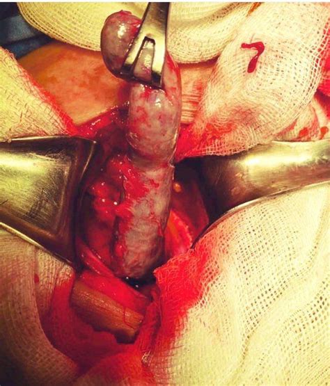 Acute Necrotic Appendicitis Scrolller