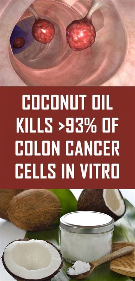 Even The Doctors Are Shocked Coconut Oil Kills 93 Of Colon Cancer
