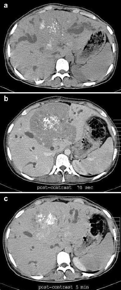 Ct Of Hepatic Alveolar Echinococcosis A Unenhanced Ct Reveals A Download Scientific Diagram