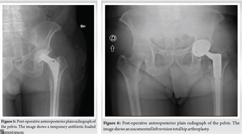 A Rare Case Of Staphylococcus Caprae Periprosthetic Hip Infection With Unusual Clinical