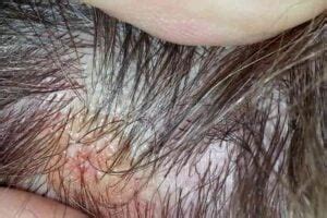 Scabs And Sores On Scalp Causes Pictures And Treatment