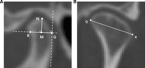 Landmarks And Linear Measurements For Condyle Morphology A Sagittal