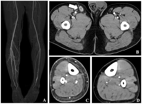 Computed Tomography Imaging Characteristics In The Diagnosis And
