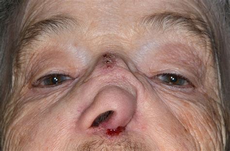 What Does A Nose Ulcer Look Like At Debra Moreland Blog