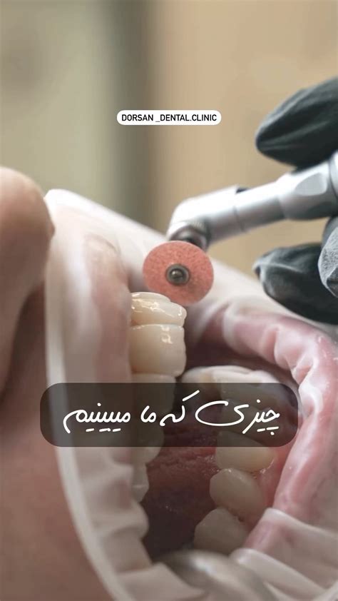 ‎ایمپلنت،کامپوزیت،لمینت،عصب کشی،جراحیکلینیک دندان پزشکی درسان