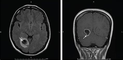 Migraine Brain Mri