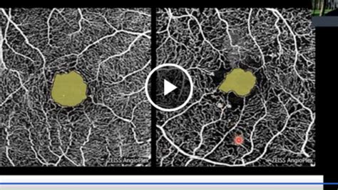 OCT Angiography Flashcards Quizlet