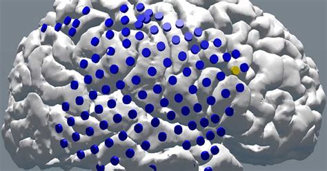 Pacemaker For Brain May Aid Memory