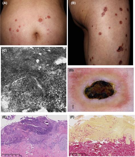 A B Multiple Pruritic Erythema Papules And Nodules With Non‐easily