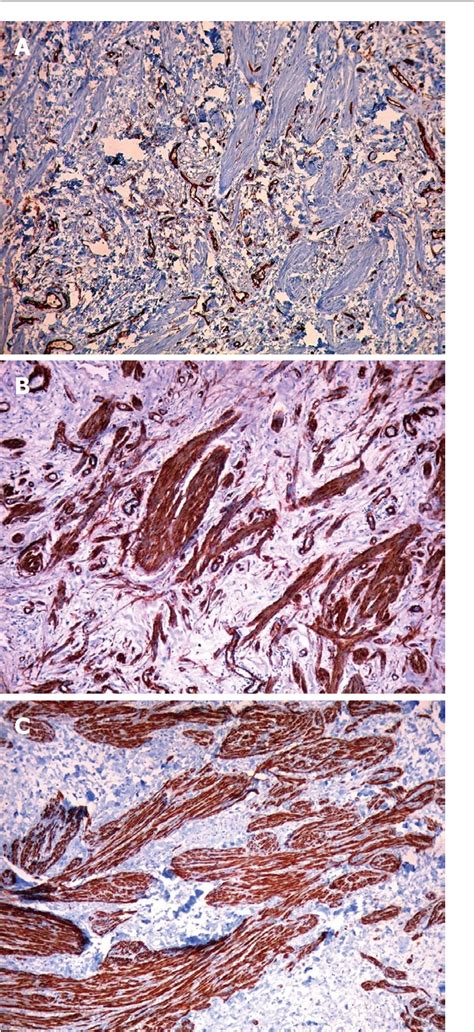 Figure 4 From Obstructive Ileus Due To A Giant Fibroepithelial Polyp Of The Anus Semantic Scholar