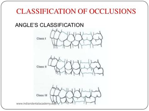 Angles Classification Reagin Orthodontics