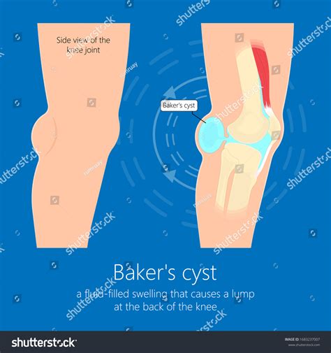 Bakers Cyst Popliteal Swelling Knee Joint Stock Vector Royalty Free
