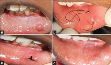 Micro Marsupialization Versus Surgical Excision For The Treatment Of Mucoceles Pmc
