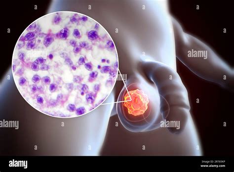 Testicular Cancer A Malignant Spermatocytic Seminoma Computer