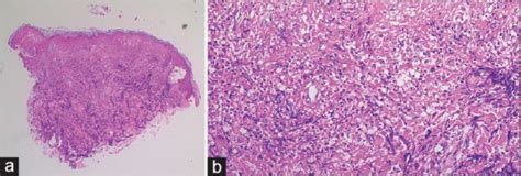 Rheumatoid Neutrophilic Dermatosis The Distinct Entity With Florid