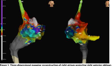 [pdf] Zero Fluroscopy Ablation For Cardiac Arrhythmias A Single Center