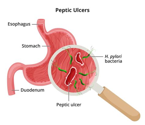 Burning Sensation In Stomach Causes Treatment And Homeopathy
