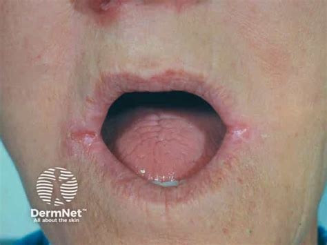 Angular Cheilitis Images — Dermnet