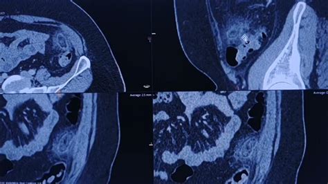 Epiploic Appendagitis Ct Findings Youtube