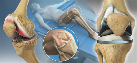 Computer Assisted Knee Replacement East Coast Orthopaedics