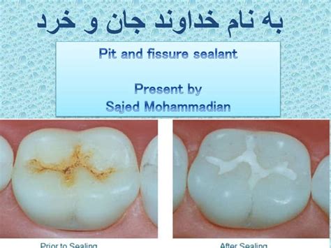 Fissure Sealant Sajed Mohammadian Pptx Dental Health Diseases And Conditions