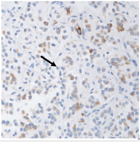 Immunohistochemical Staining For Inhibin Showing Cytoplasmic Positivity
