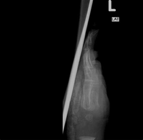 Subcutaneous Calcification Of The Dorsal Aspect Of The Left Hand Download Scientific Diagram