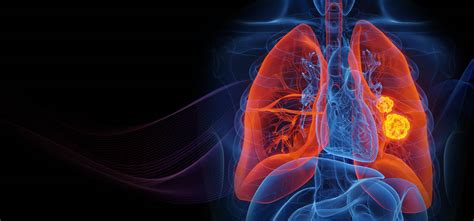 Lung Cancer Screening