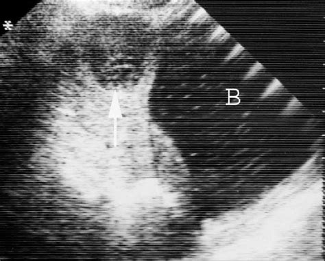Abscess Collection From A Perforated Appendix Ultrasonography In The Download Scientific