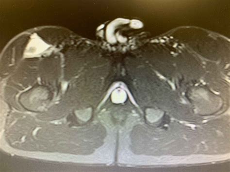 Rectus Femoris Injury Information Urheiluortopedi Lasse Lempainen