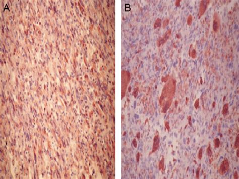 Epithelioid And Spindle Cells Of Gist Were Positive For C Kit Cd117 Â