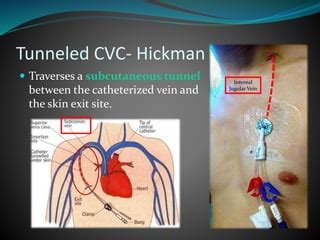 Hickman Catheter An Overview Details About Hickman Insertion Care Maintenance Removal