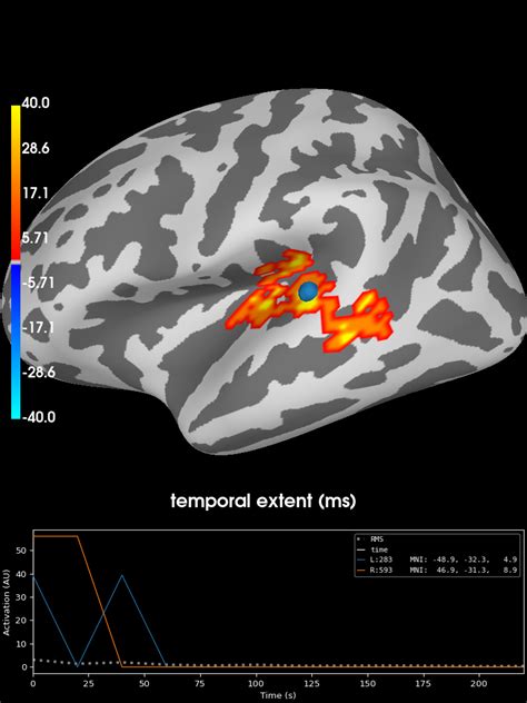 Permutation T Test On Source Data With Spatio Temporal Clustering — Mne