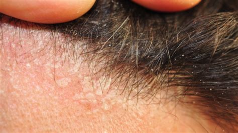 16 Reasons You May Have An Itchy Scalp And What You Can Do About It