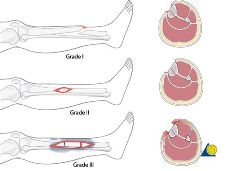 Cluelessmedic — Classification Of Compound Fractures Gustilo