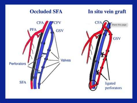 Bypass Grafts Flashcards Quizlet Bypass Grafts Flashcards Quizlet