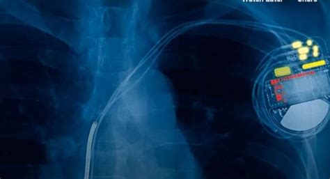 This Ultra Thin Minimally Invasive Pacemaker Can Be Controlled By Light