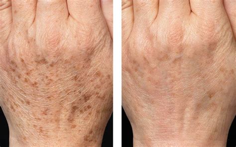 6 მოქმედი საშუალება პიგმენტურ ლაქებთან საბრძოლველად წარმოუდგენელი