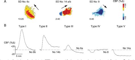 Figure 1 From Propagation Of Cortical Spreading Depolarization In The Human Cortex After