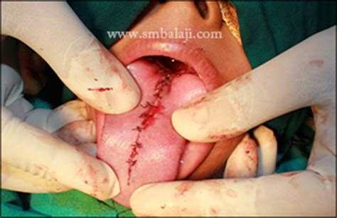 Surgical Correction Of Macroglossia Enlarged Tongue Best Dental