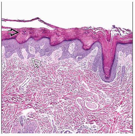 Ichthyosis Vulgaris Histology