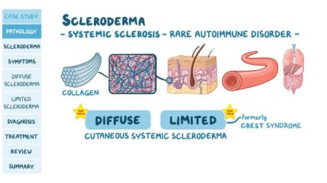 Scleroderma Pathology Review Video And Anatomy Osmosis