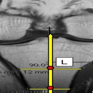 Longitudinal Axis Of The Tibia In The Coronal Plane L Download Scientific Diagram