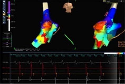 3d Electroanatomical Mapping System Showing Ablation Catheter With Good